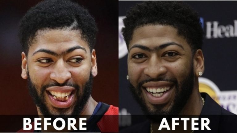 Anthony Davis Teeth Transformation [Updated]: Before & After